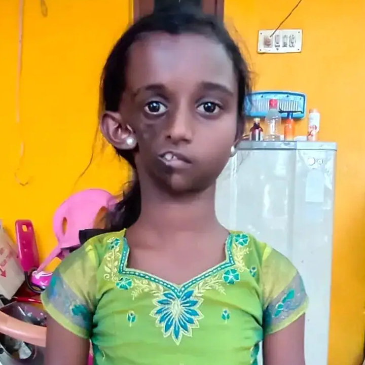 முகச்சிதைவு நோயால் பாதிக்கப்பட்ட சிறுமி டானியாவுக்கு அறுவை சிகிச்சை ...